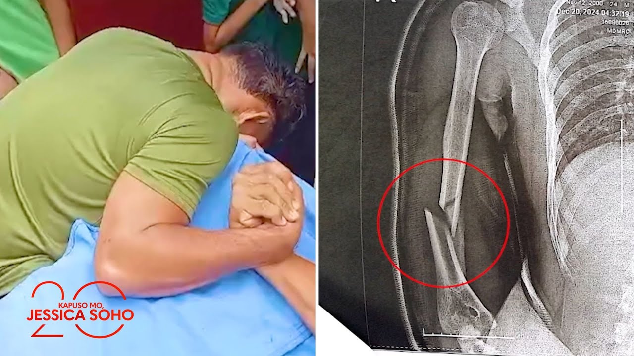 Lalaki, aksidenteng nabalian ng buto sa pakikipag-buong braso! | Kapuso ...