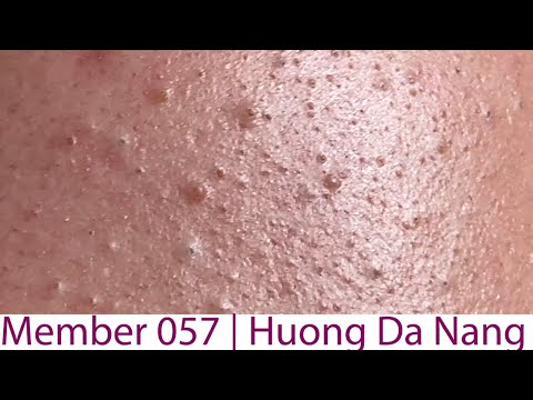 Acne Treatment Huong Da Nang# 057 |  Member 2023