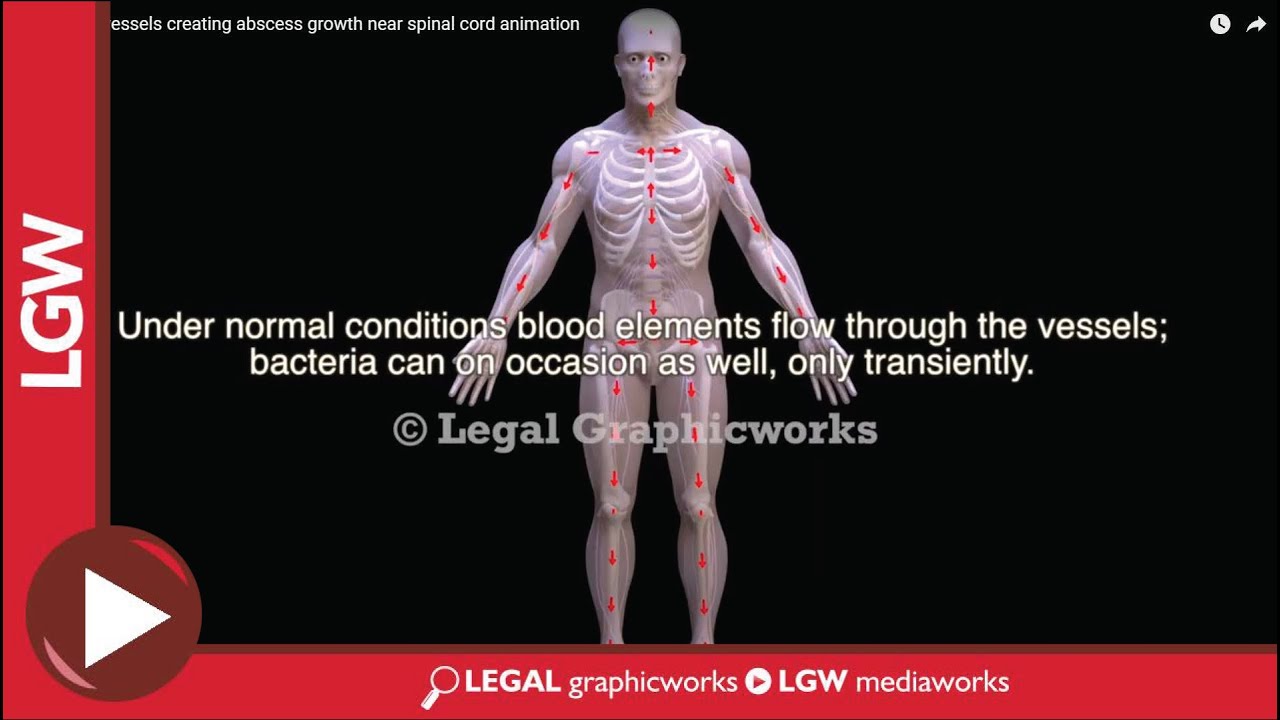 Bacteria in vessels creating abscess growth near spinal cord animation ...