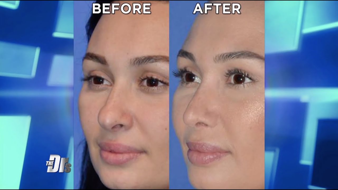 Dr. Ghavami on The Doctors Show - Rhinoplasty Before and After ...