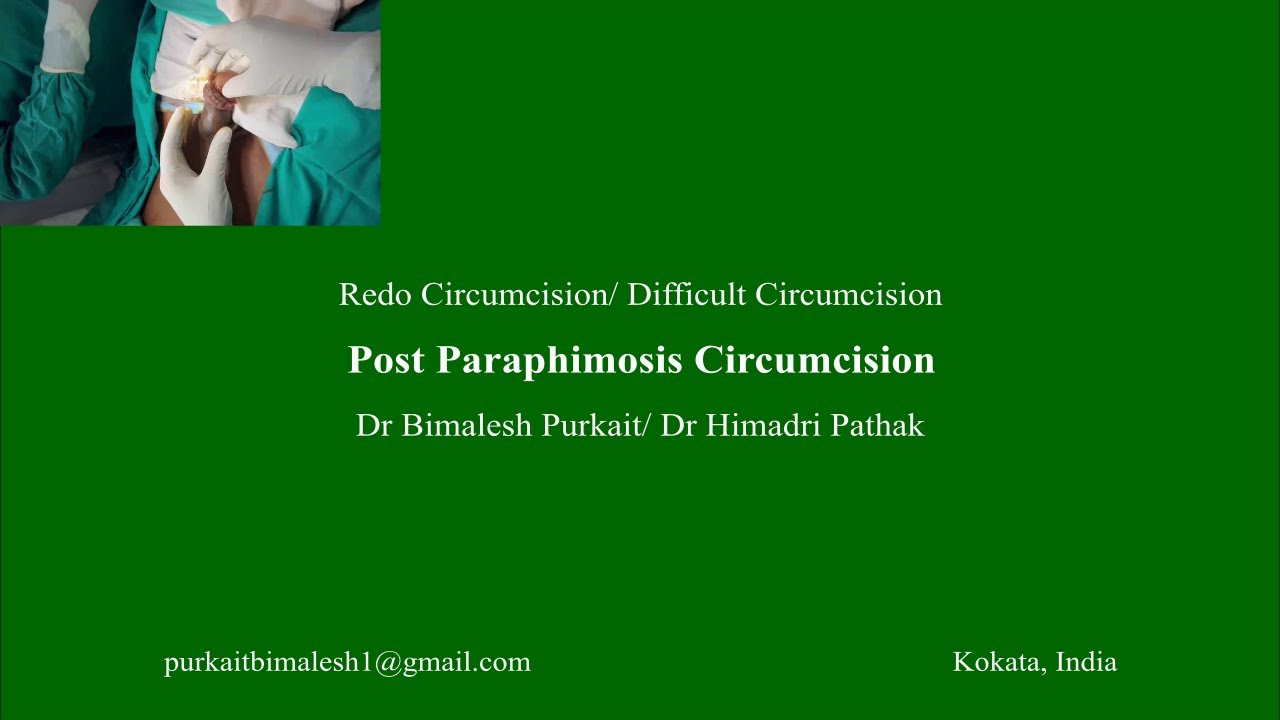 Dr Bimalesh Purkait: Difficult Circumcision / Post Paraphimosis ...