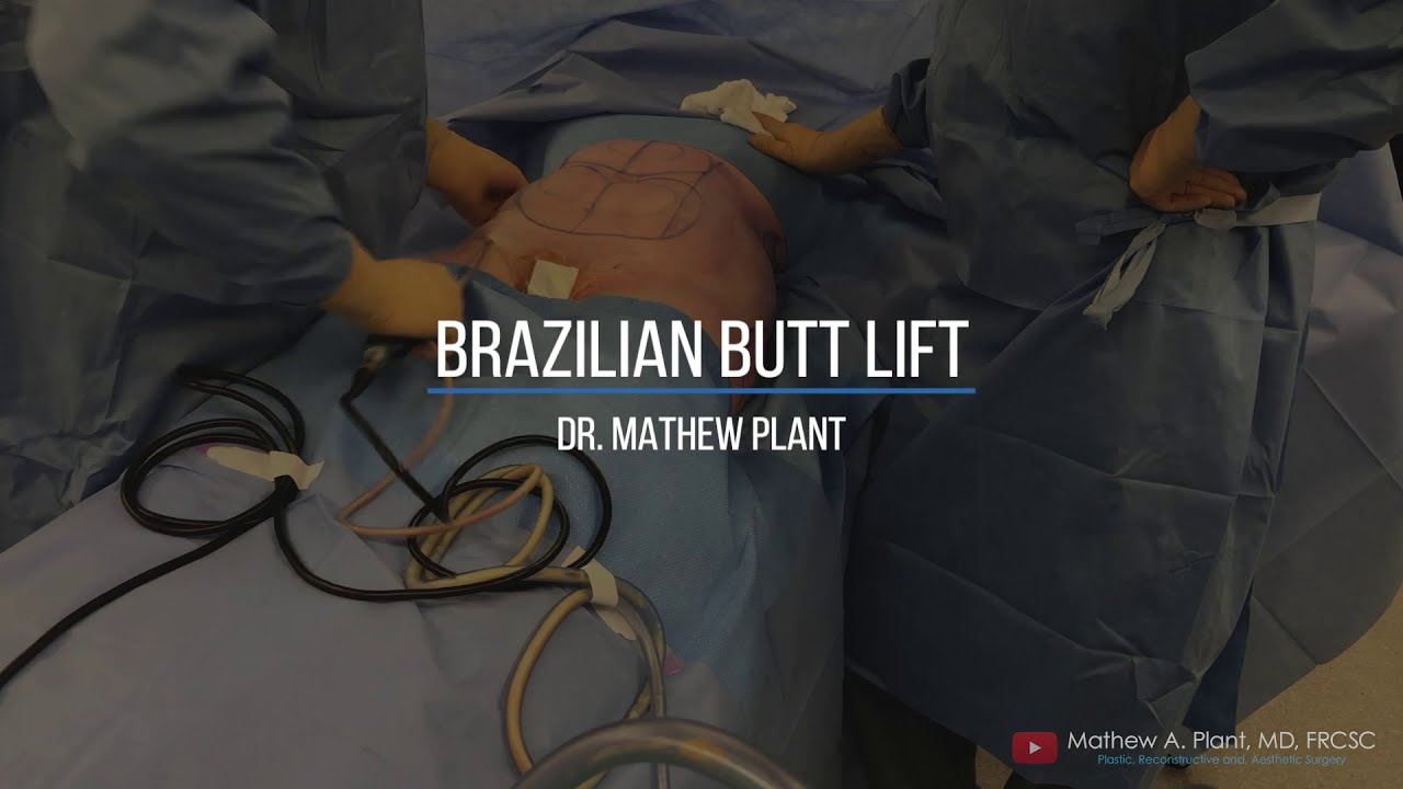 BRAZILIAN BUTT LIFT | How a BBL is really done by a Toronto Board ...
