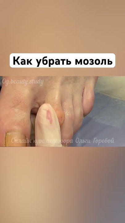 Удаление мозоли Youtube