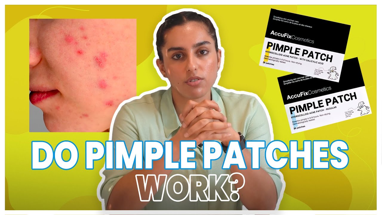 How to Treat acne in one day? How Pimple Patches Work?? 2 types of ...