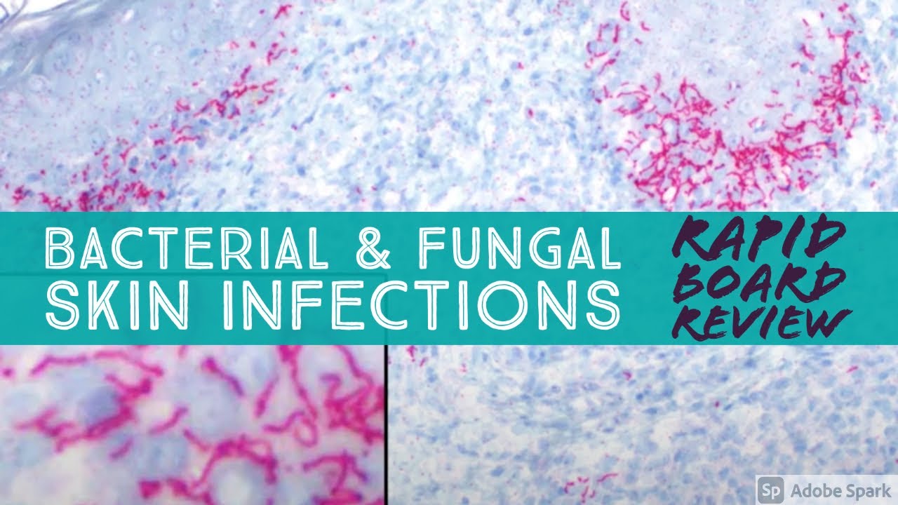 Infectious Dermpath (bacterial & fungal): Board Review for Dermatology ...