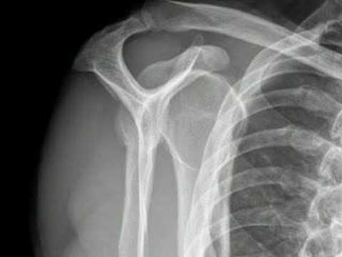 Dislocation Reduct Shoulder (sample) - proceduresconsult.com - YouTube
