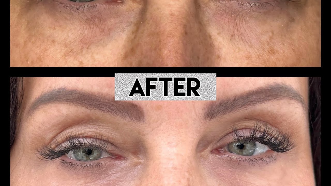 Pt Testimonial after 3 Tixel Eyes & 3 Polynucleotide treatments for ...