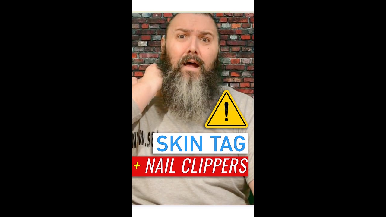 Removing SKIN TAGS with NAIL CLIPPERS! - Don't try this at home - YouTube