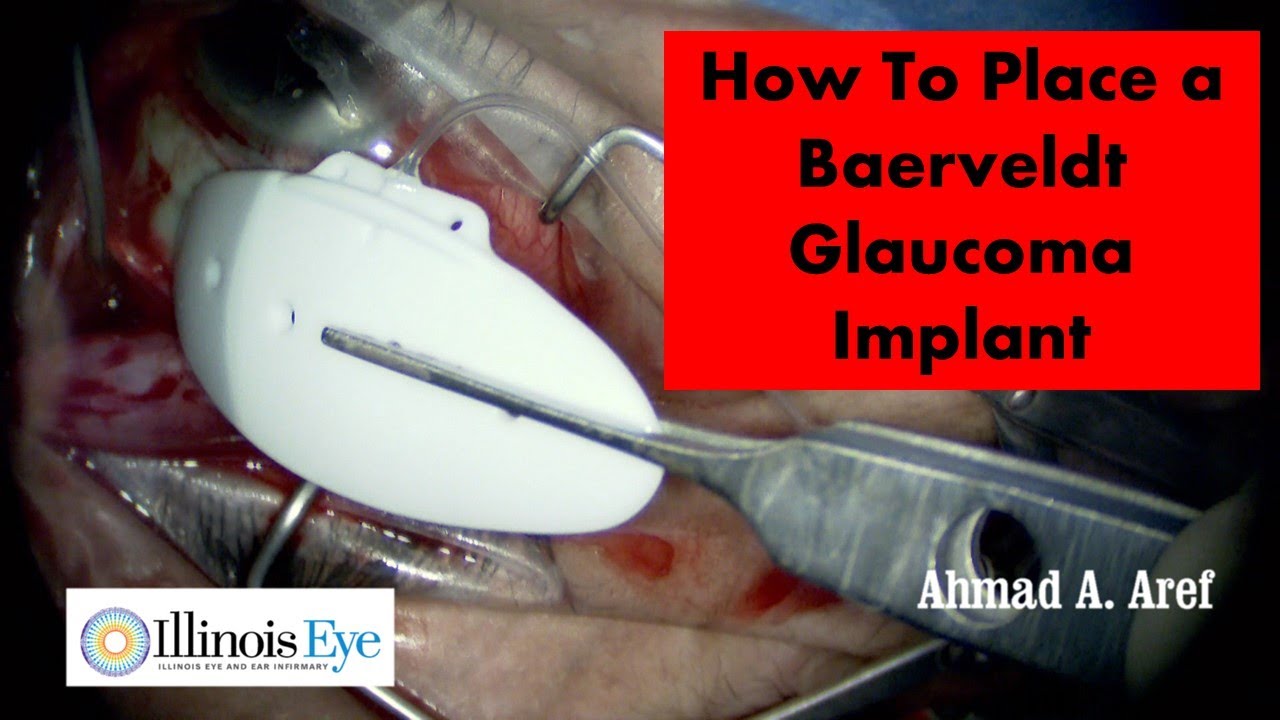 How to Place a Baerveldt Glaucoma Implant - YouTube