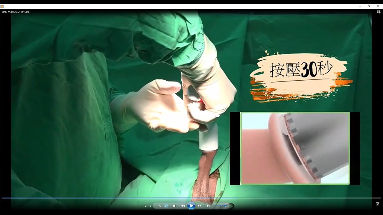 circumcision包皮手術 - YouTube