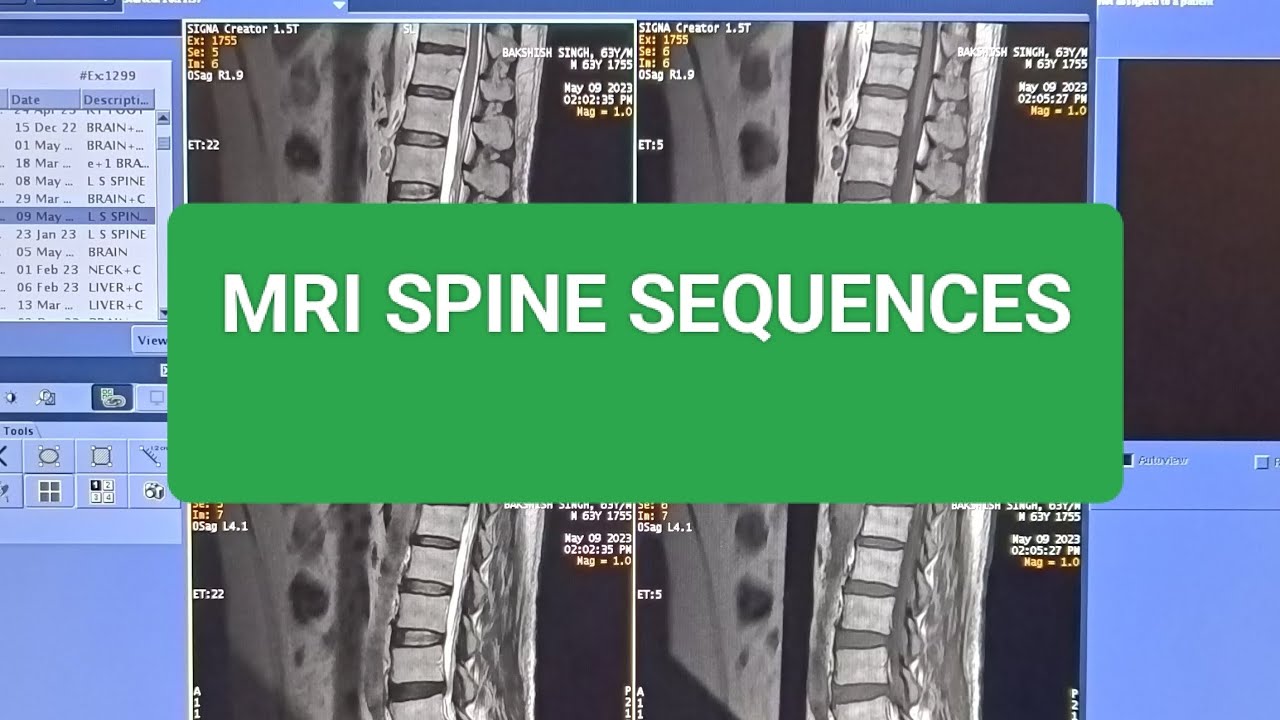 MRI Spine sequences #Mri spine main sequences ko kese phachane #Ls spine mri sequences - YouTube