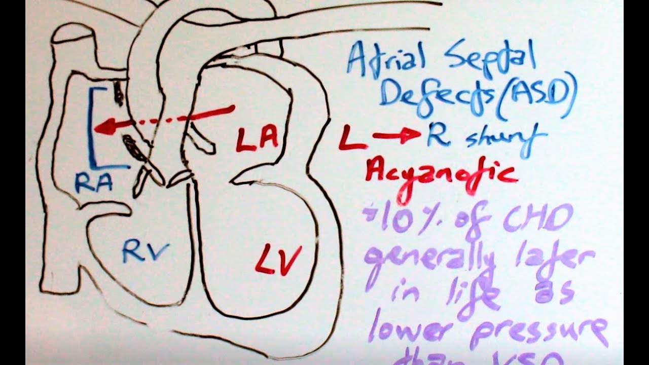 Atrial Septal Defects: embryology, presentation, diagnosis & treatment ...