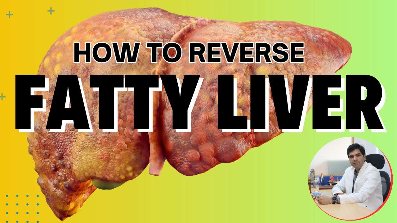 How To Reverse Fatty Liver Naturally? - YouTube