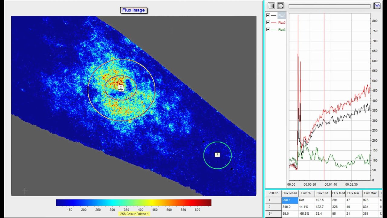 Wheal, flare and axon reflex response from intra-dermal injection - YouTube