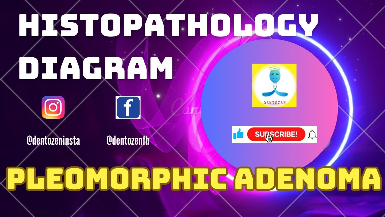 Histopathology diagram of Pleomorphic Adenoma - YouTube