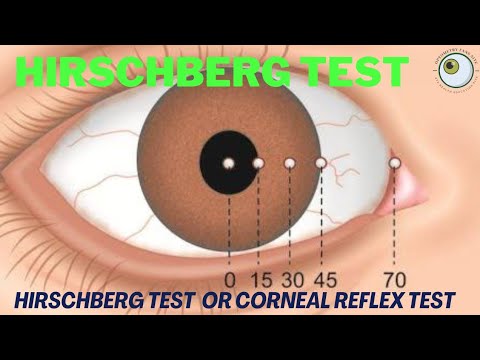 hirschberg corneal reflex tes | how to perform hirschberg test ...