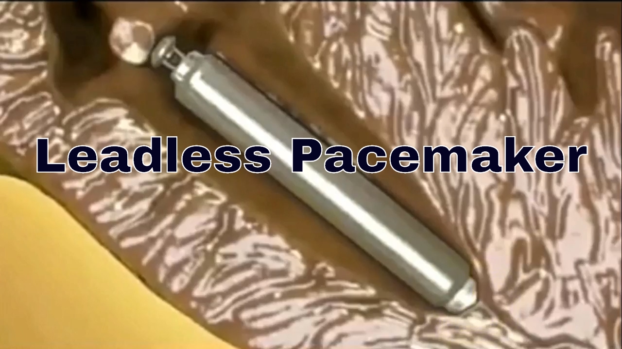 Cardiac pacemaker implantation leadless - YouTube