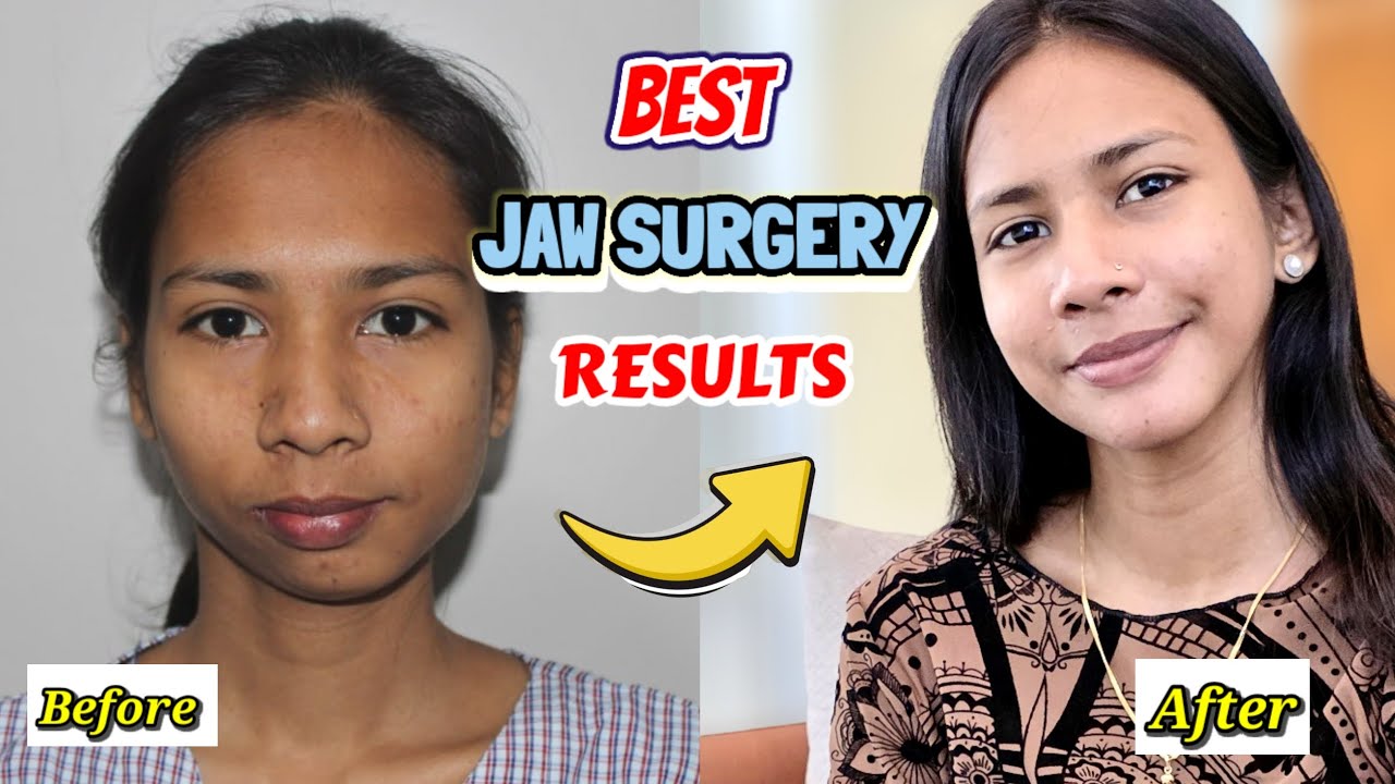 Best Jaw Surgery Before & After Results | Underbite, Overbite, Facial ...