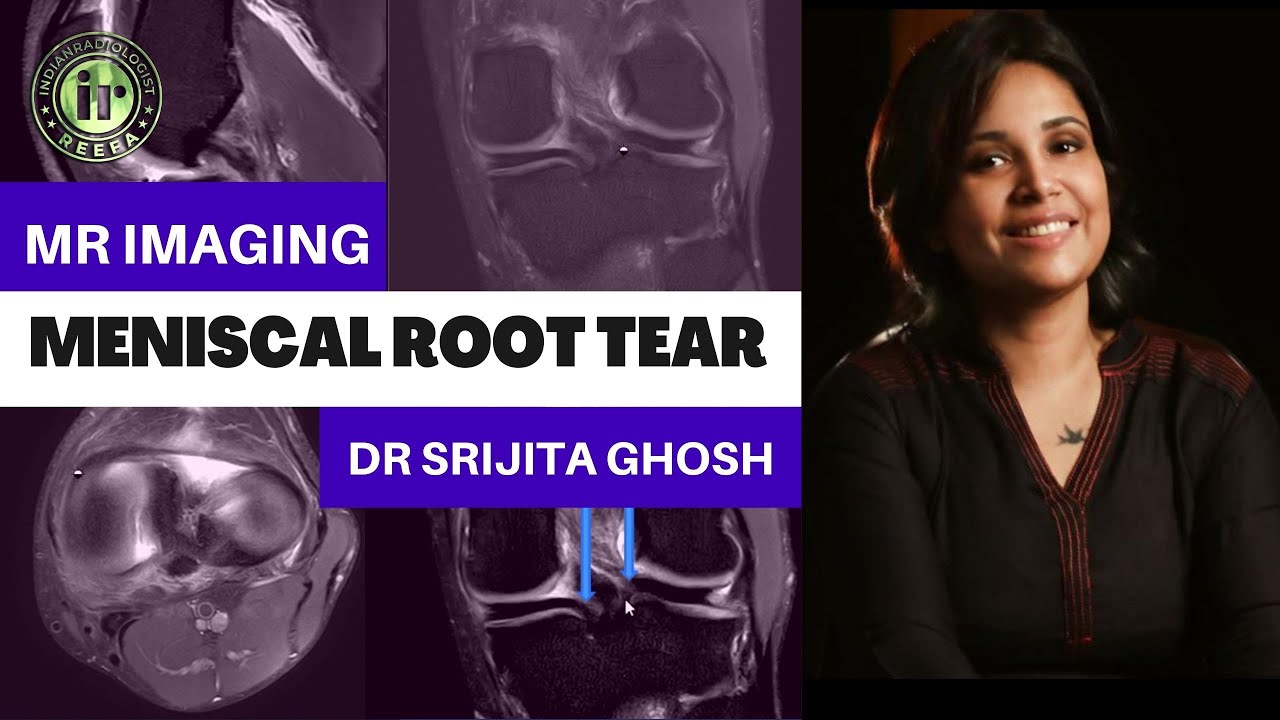 MENISCAL ROOT TEAR | SRIJITA GHOSH | MRI KNEE | MENISCAL TEARS | ROOT ...