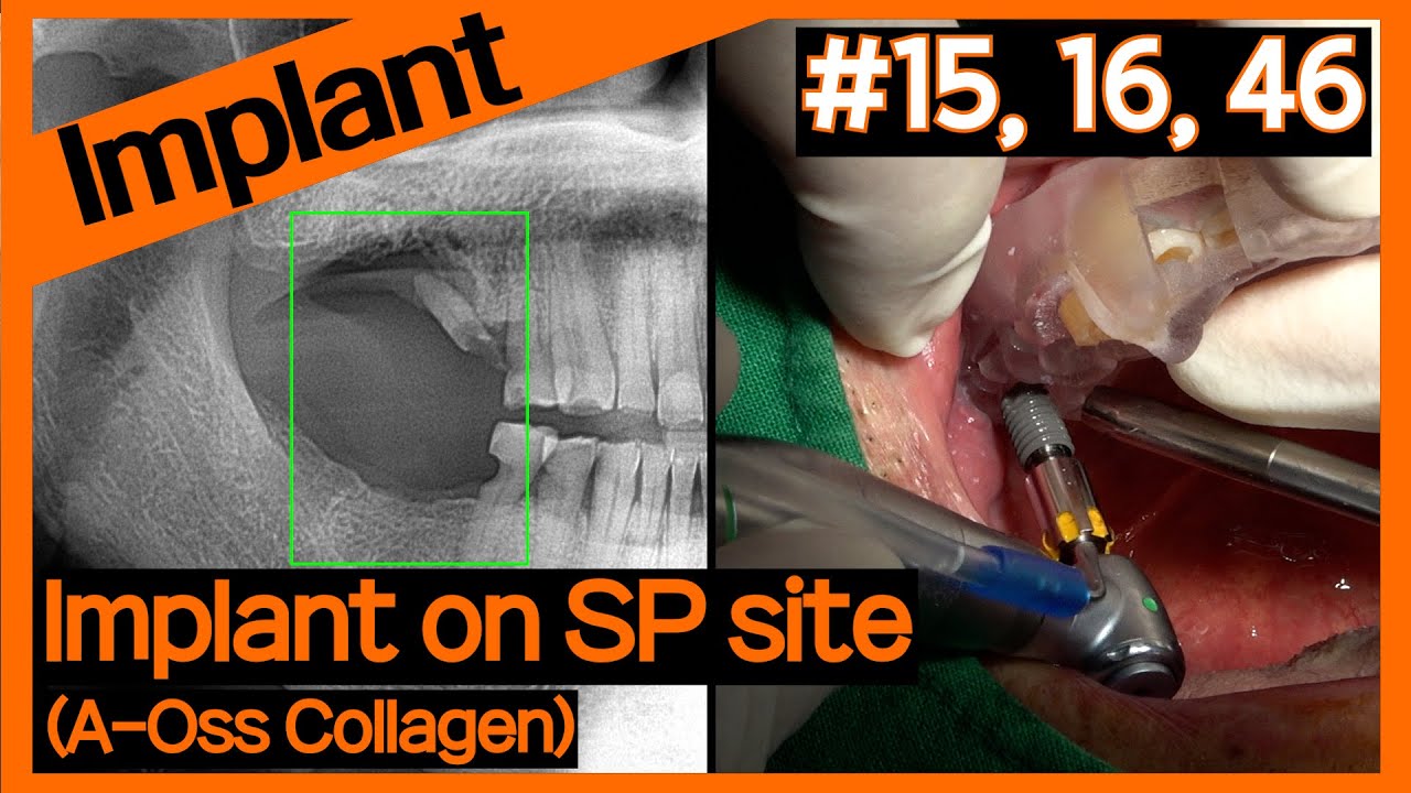 [Online Surgery] OneGuide implants on #15, #16, #46 after SP using A ...