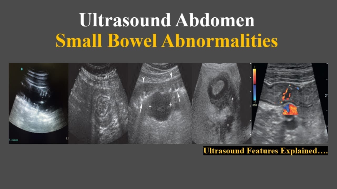 Ultrasound features of small bowel abnormalities || Radiology cases ...