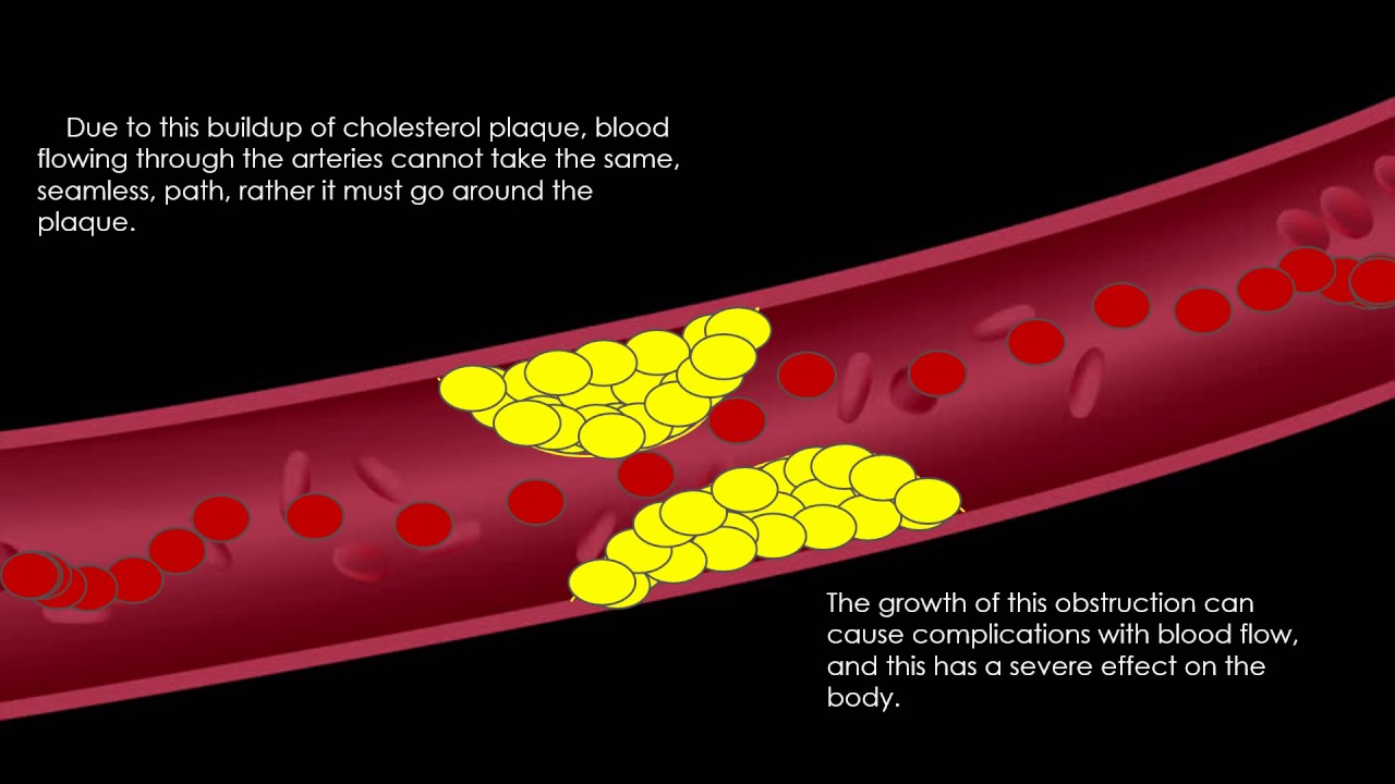 Animation of Atherosclerosis Biology Summative - YouTube
