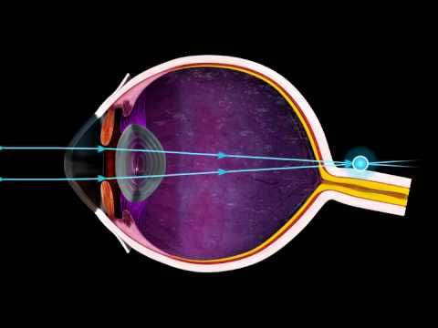 Short Sighted and Long Sighted - 3D Medical Animation of the Eye || ABP ...