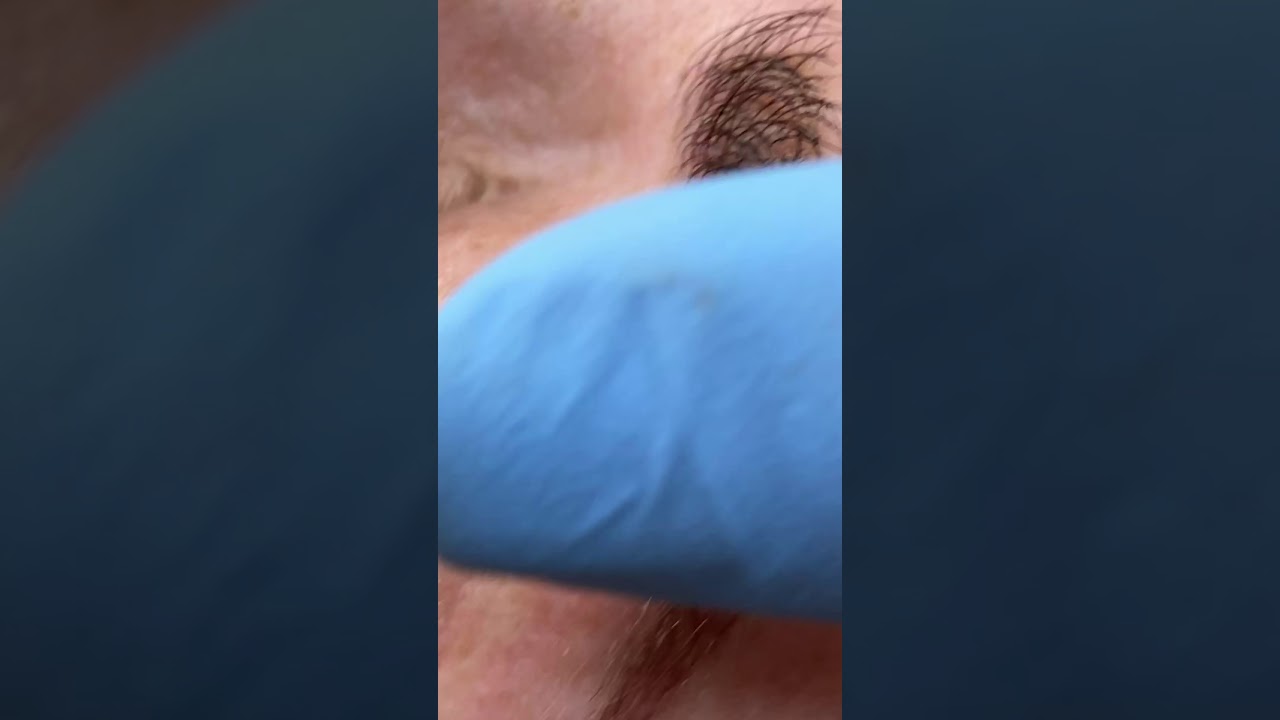 Dangers of microblading long term damage scars caused by microblading ...