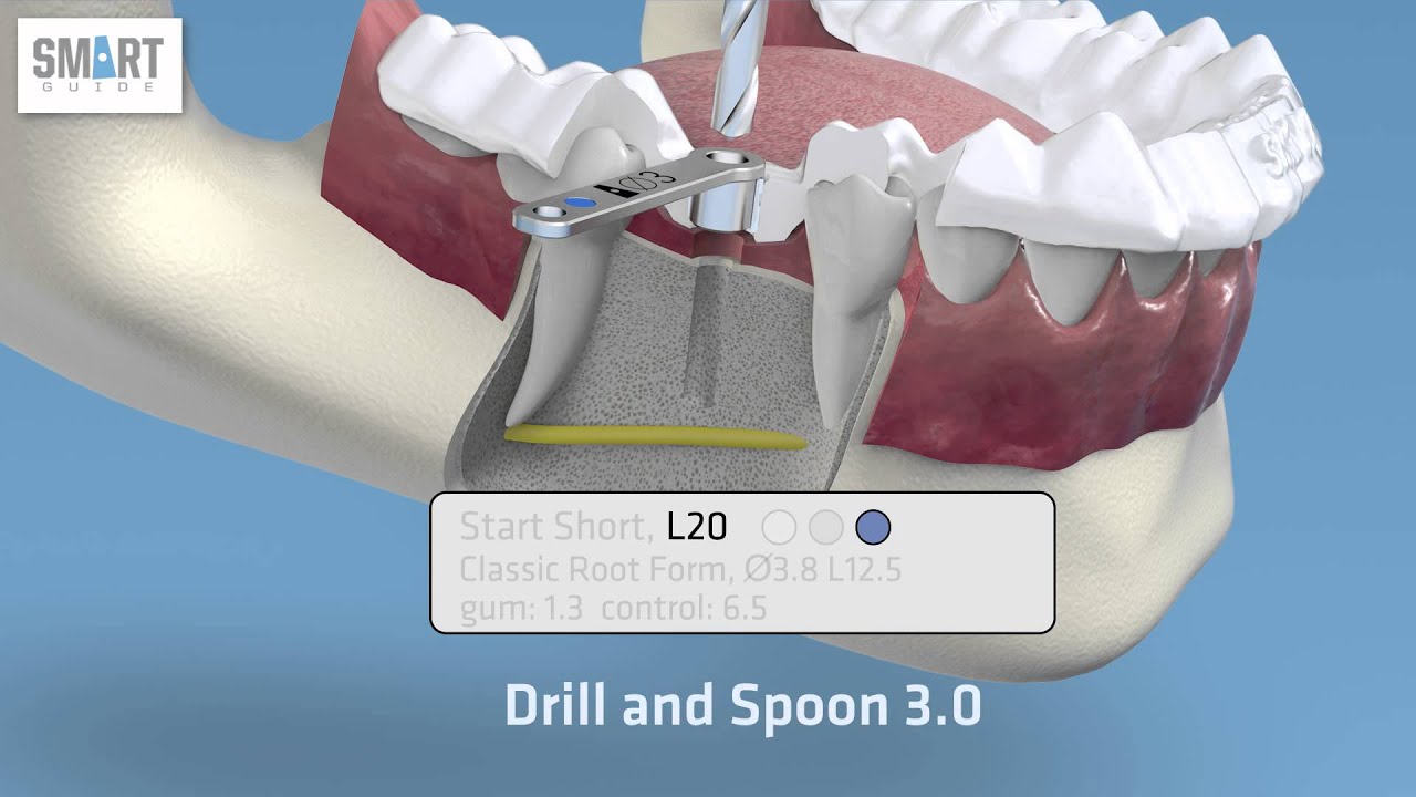 SMART Guide Surgical Animation - YouTube