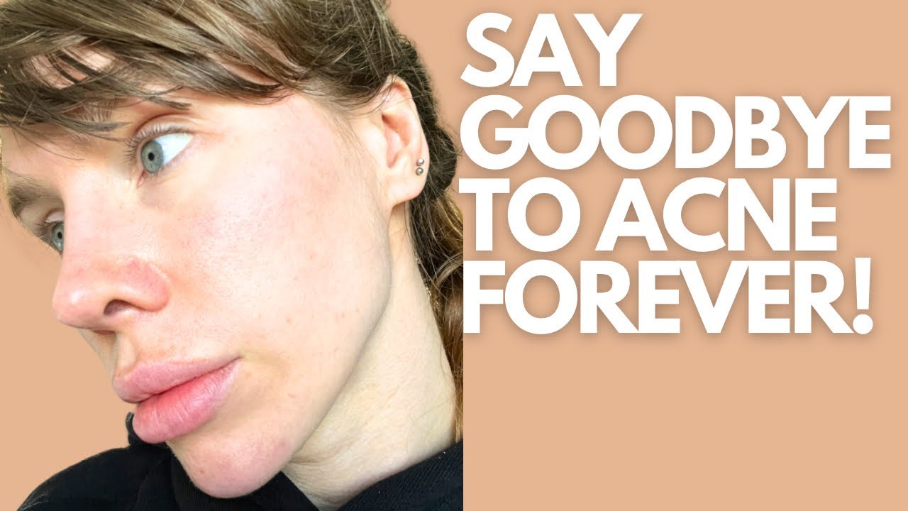How I Cleared My Skin Without Expensive Treatments! | My Real Skin Up ...