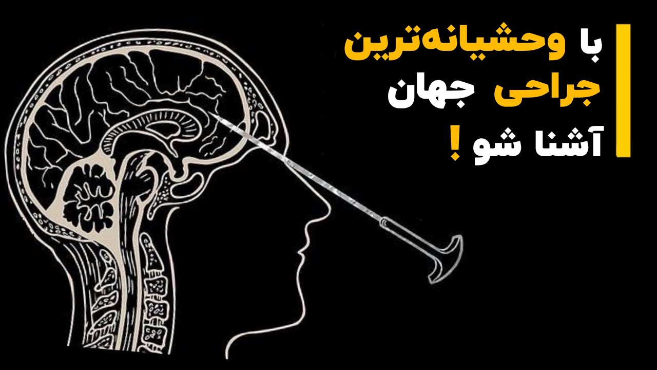 لوبوتومی ؛ وحشیانه ترین جراحی جهان Youtube