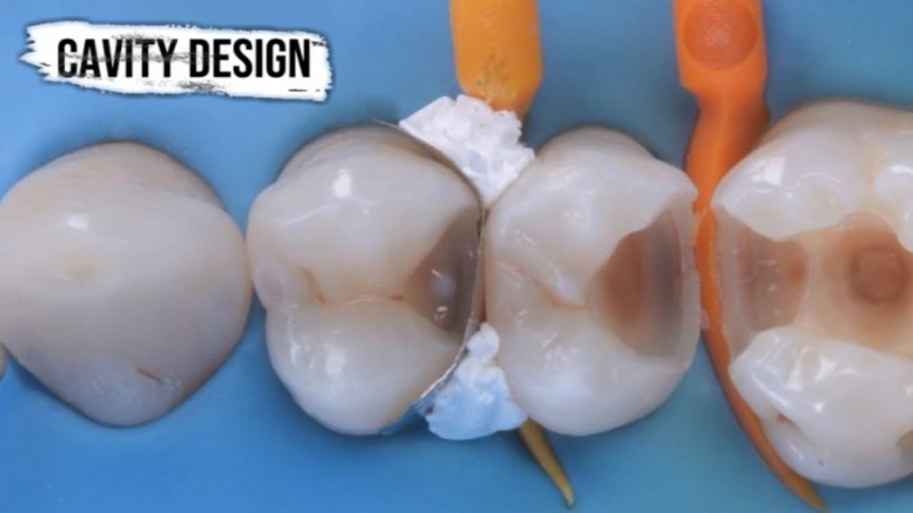 Cavity Design For Composite Restoration - YouTube