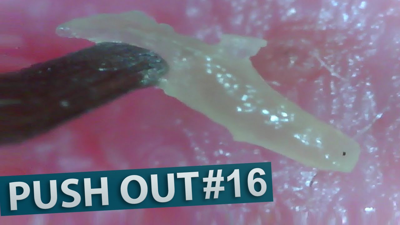 #16 Push Out(Squeezing)Blackheads Close up | ピンセットで角栓を押し出し除去 - YouTube