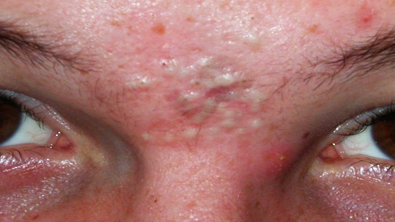 Blackheads and Macro Comedones! (Defined) - YouTube