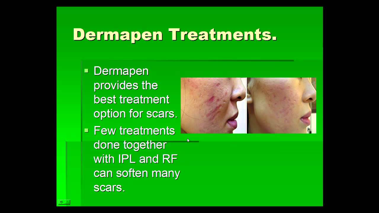 Skin Resurfacing with dermapen is best for acne scars wrinkles and ...