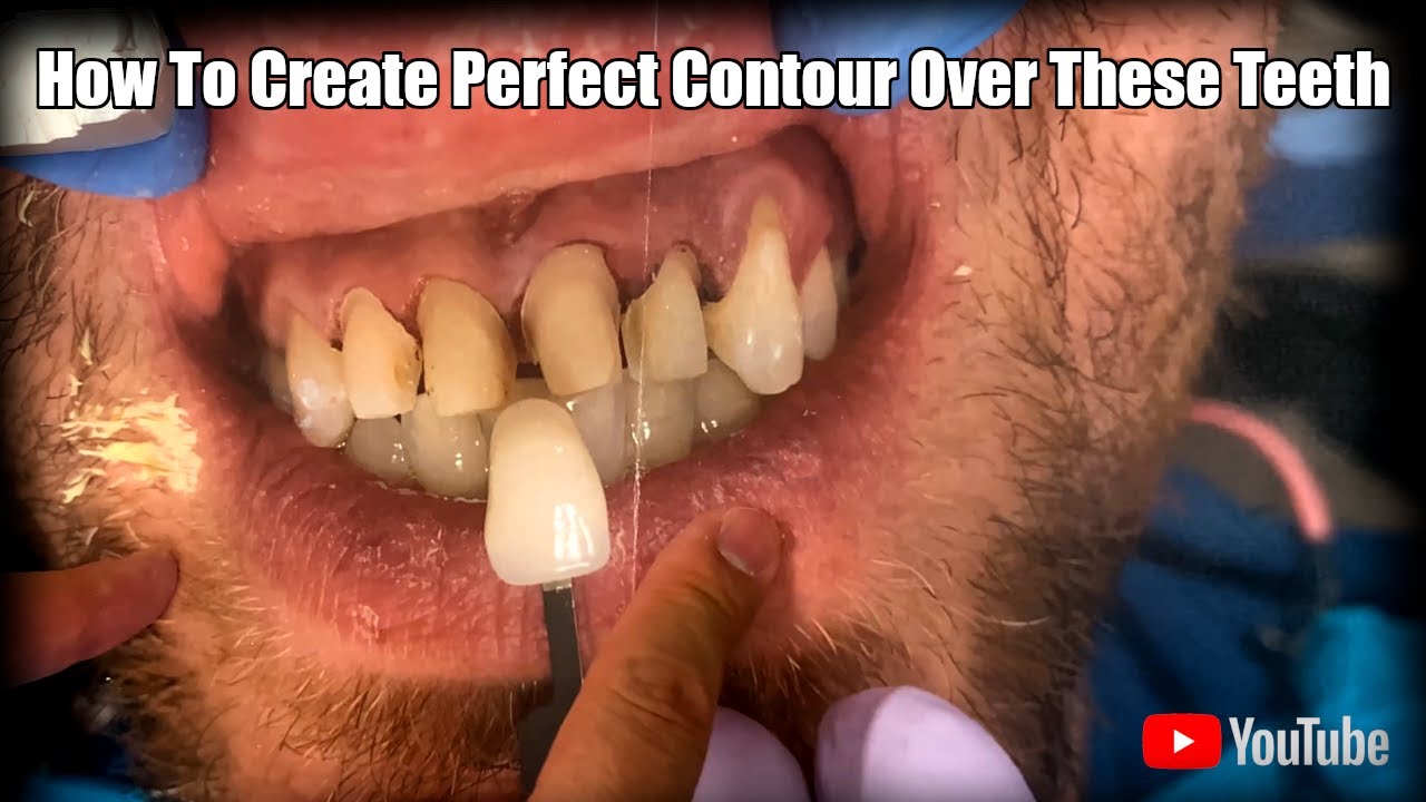 How to Create Perfect Contour Around Crooked Anterior Teeth with Gaps ...
