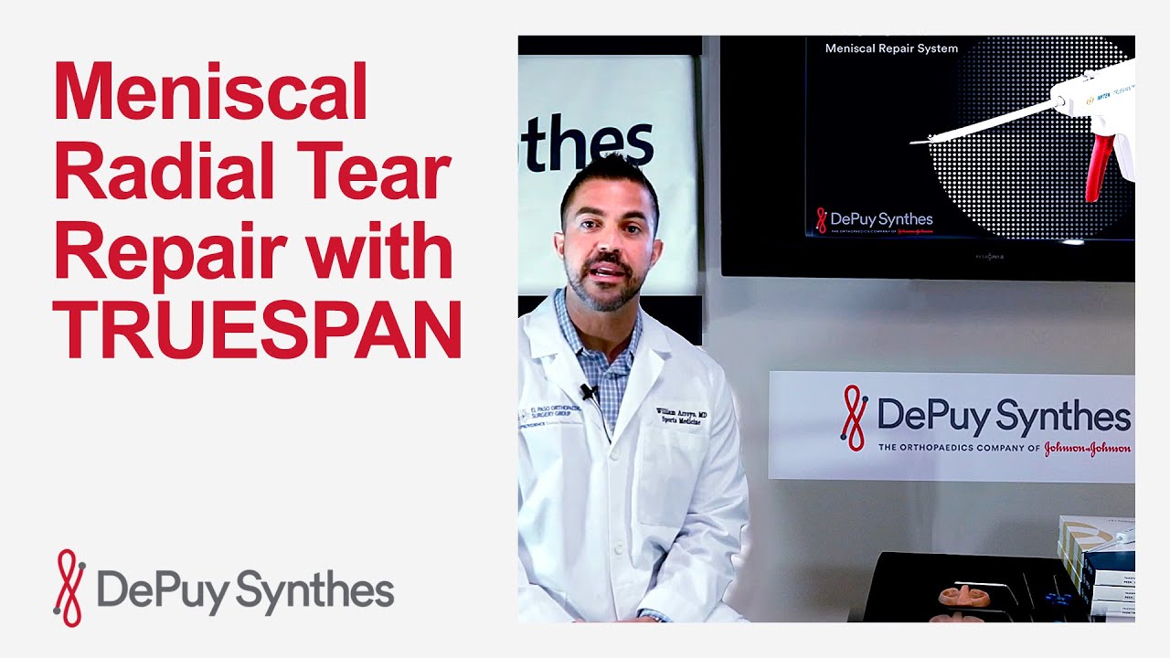 All-Inside Radial Meniscal Tear Repair with TRUESPAN Meniscal Repair ...