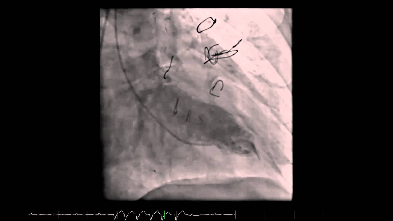 Ventriculogram - YouTube