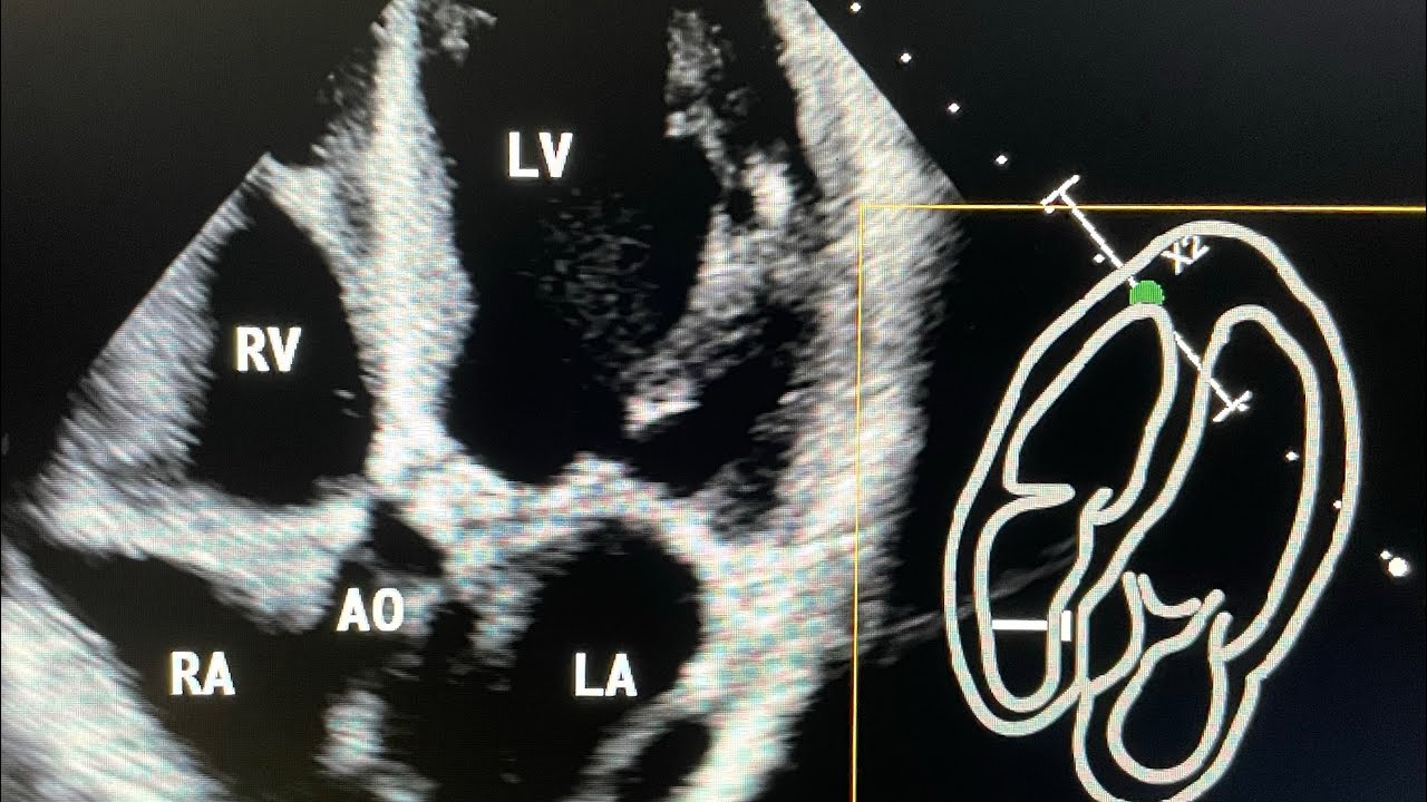 Unicuspid Aortic Valve, Severe Aortic Stenosis &Severe LV systolic ...