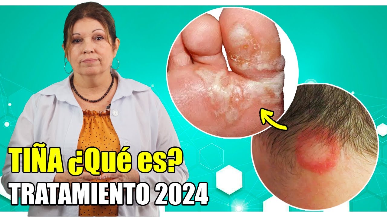 🛑 TIÑA del pie ¿Qué es? 😳 Tratamiento actualizado 👈 - YouTube