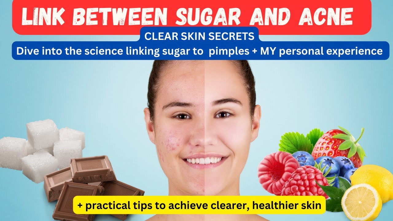 LINK between SUGAR and ACNE revealed! 🍰 - YouTube