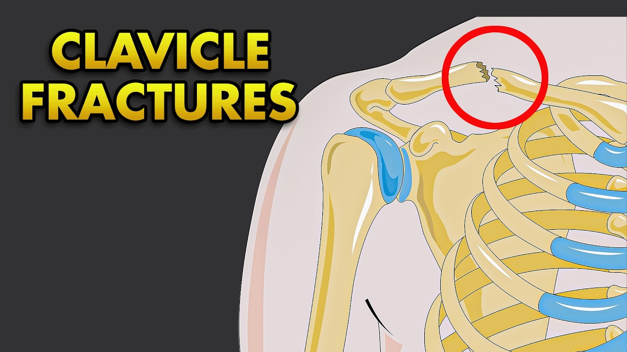 Clavicle Bone Fractures: Anatomy, Classification, Clinical Features and ...