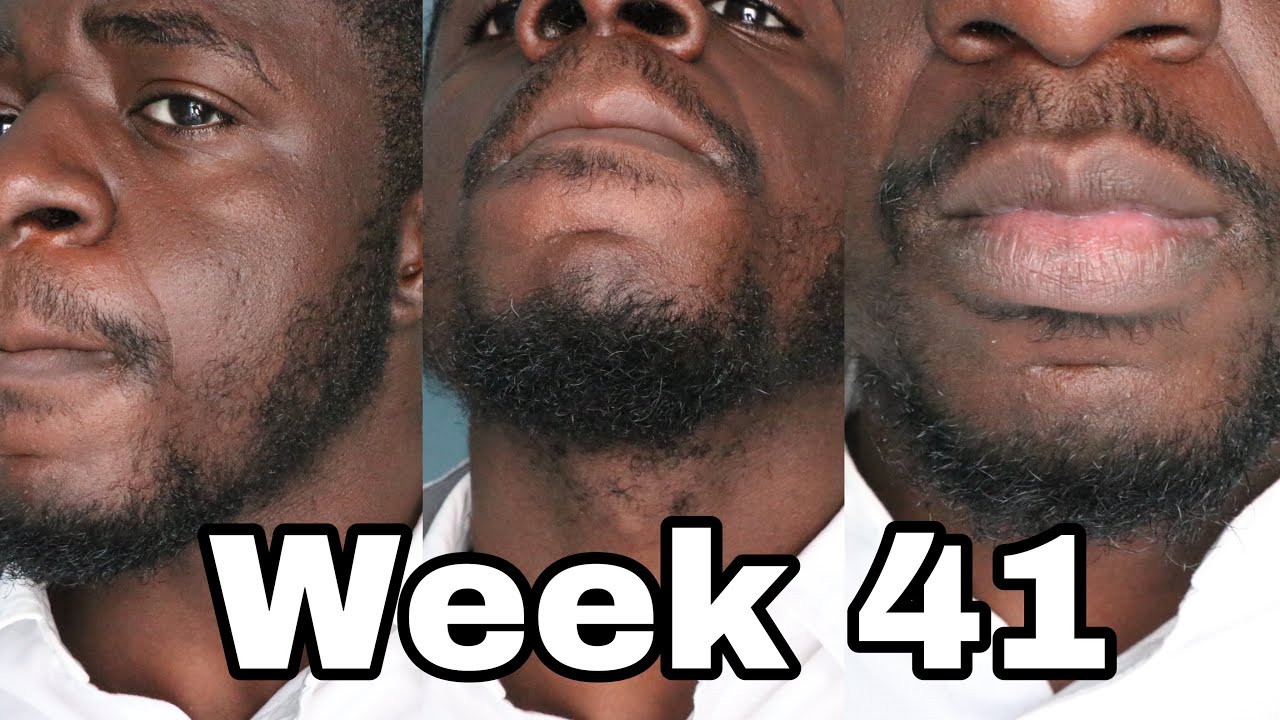 HOW TO GROW A BEARD WITH MINOX- MINOXIDIL JOURNEY WEEK 41 - YouTube