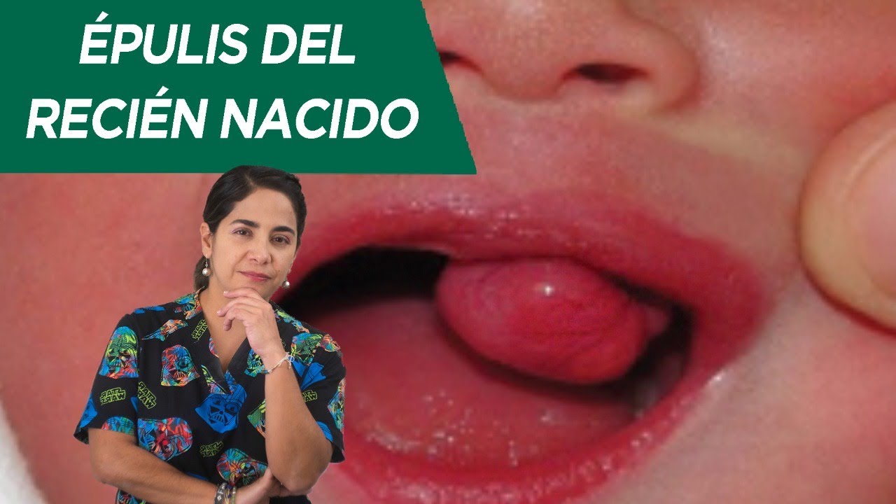 Épulis del recién nacido - YouTube