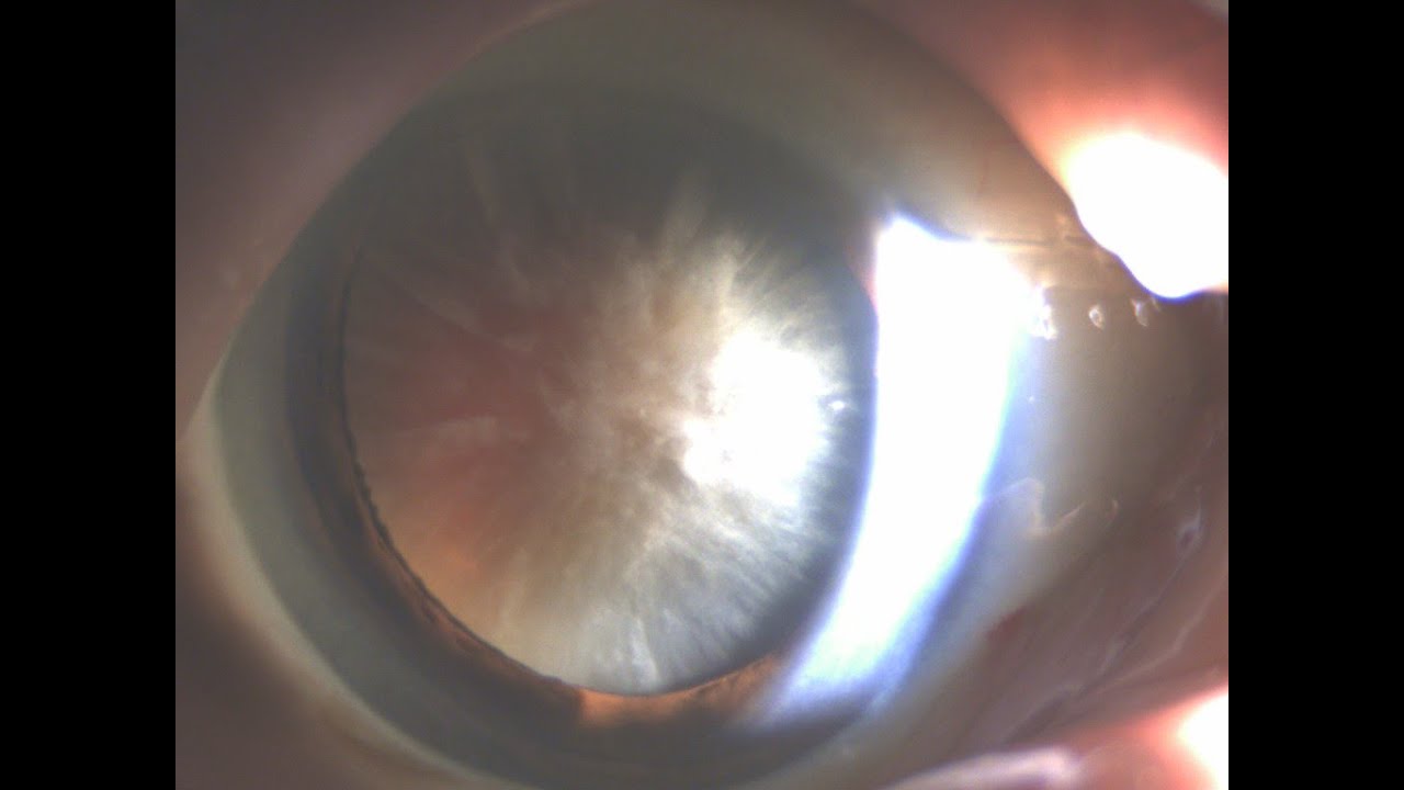 Very Dense Brunescent Cataract Surgery Phaco Chop Hoya Iol Youtube