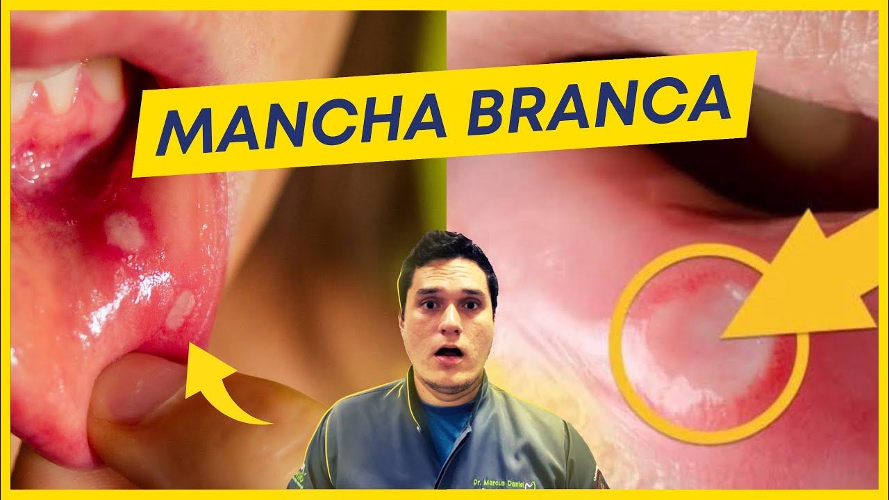 MANCHA BRANCA NO LÁBIO, O QUE PODE SER? - YouTube