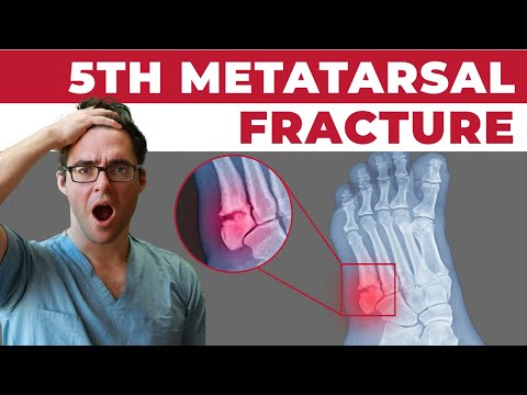 How Long To Recover From Jones Fracture Surgery