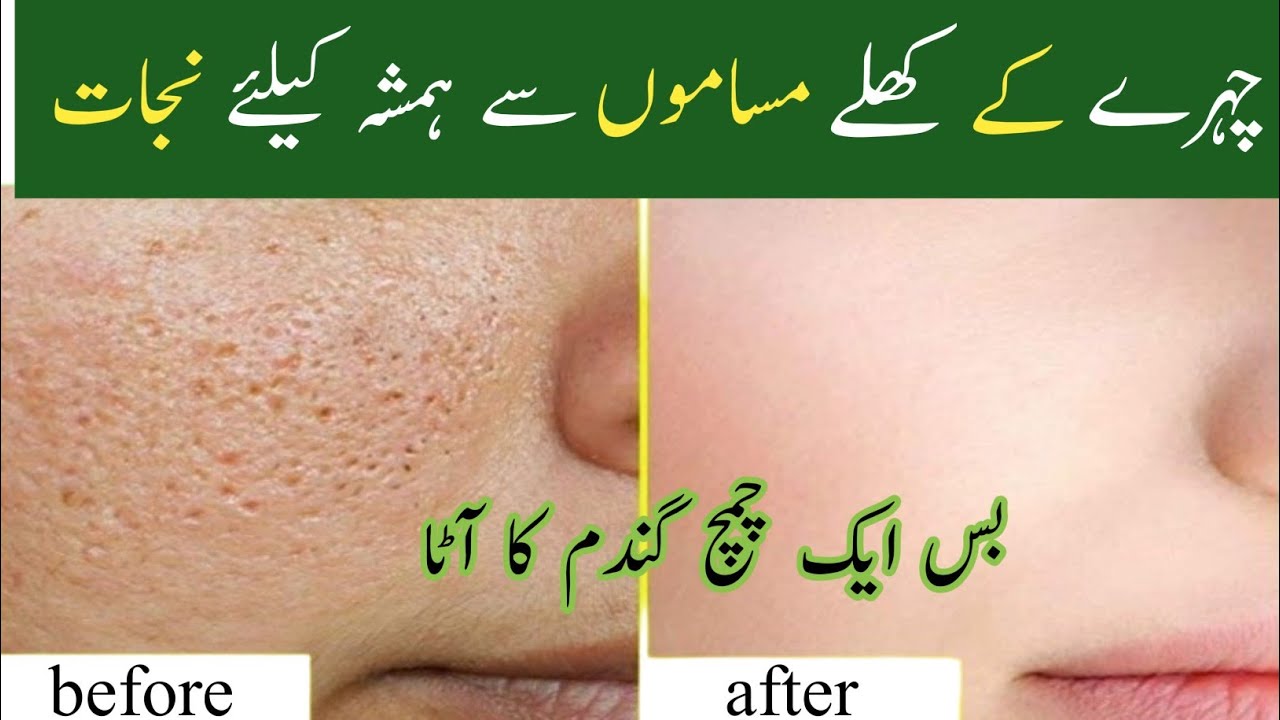 How To Get Rid Of Open Pores on Face|remove open pores & dark spots ...