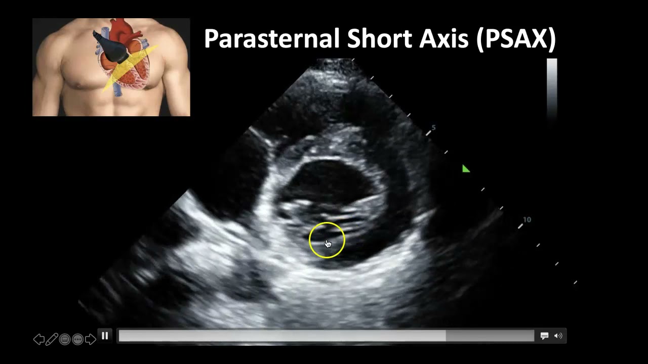 Cardiac Ultrasound: Basic Windows and Anatomy - YouTube