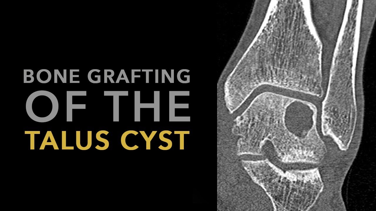 Bone grafting of the talus cyst - YouTube